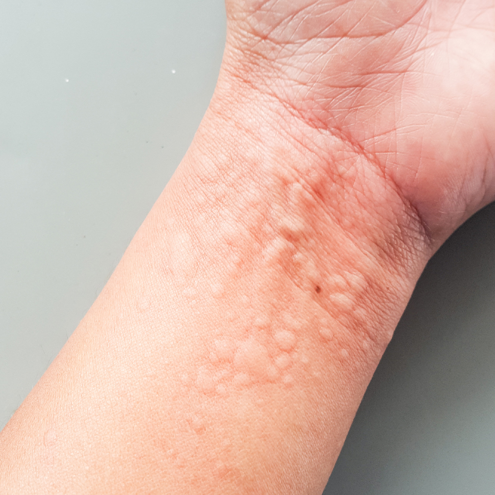 Wat is netelroos en hoe verminder je klachten? | Allergie symptomen