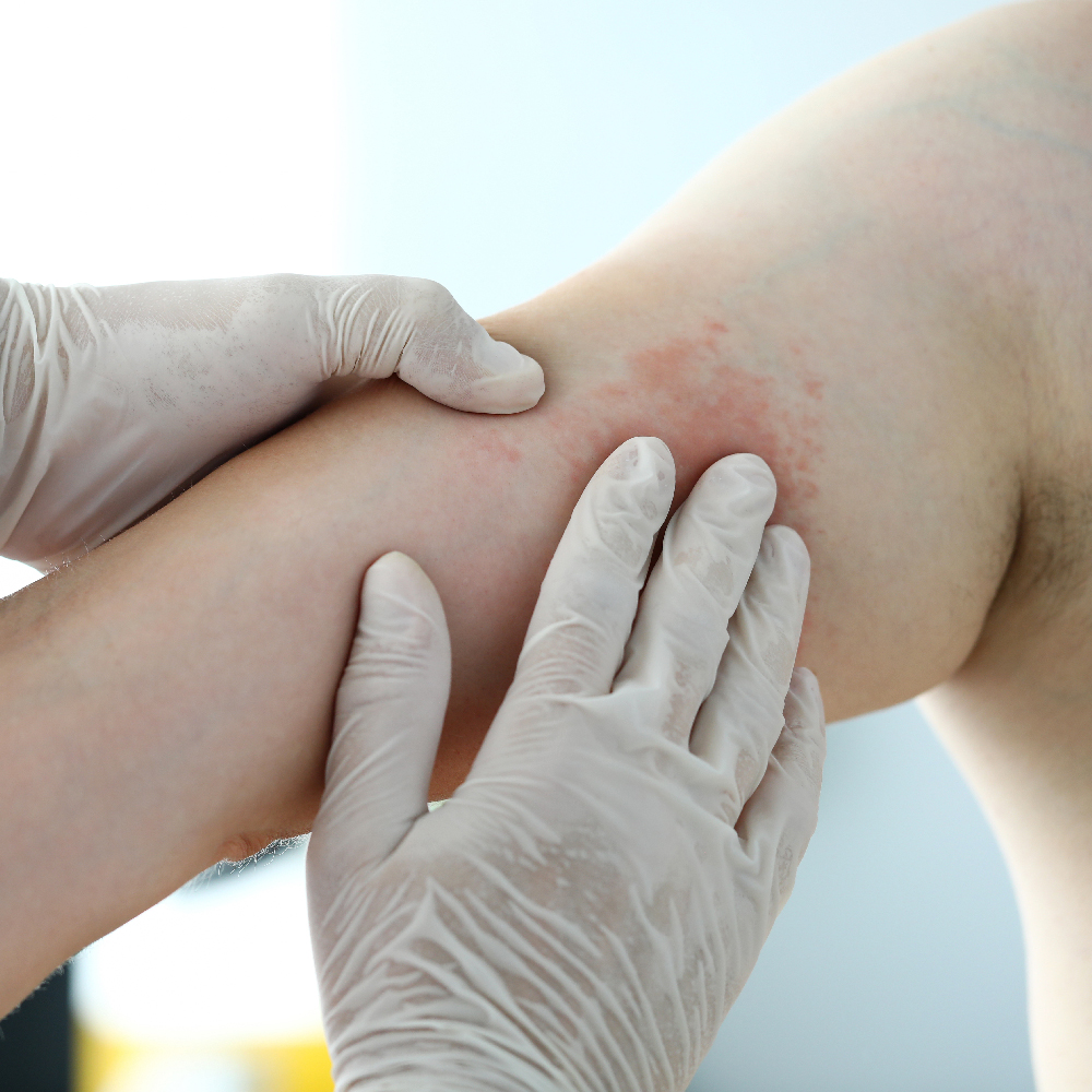 Qu’est-ce que l’urticaire et comment soulager les plaintes ...