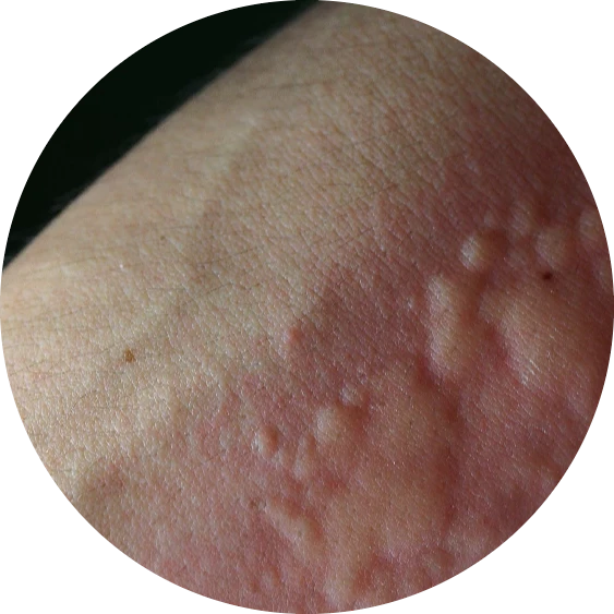 Wat is netelroos en hoe verminder je klachten? | Allergie symptomen