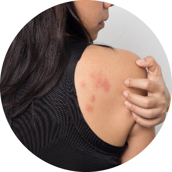 Wat is netelroos en hoe verminder je klachten? | Allergie symptomen