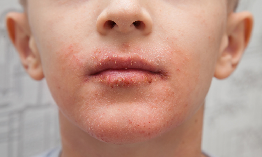 De l'eczéma sur le visage, que pouvez-vous y faire? | EG